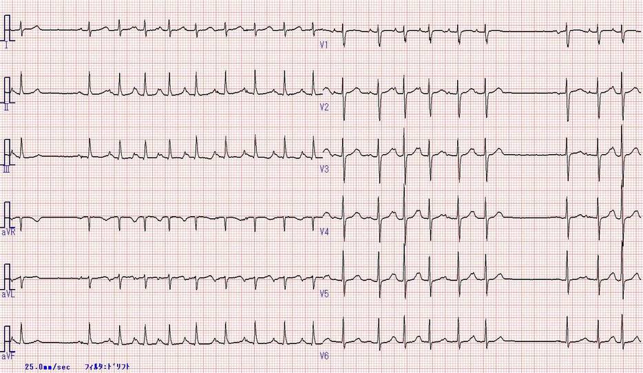 松下心電塾 Matsushita ECG School 松下心電塾 Matsushita ECG School